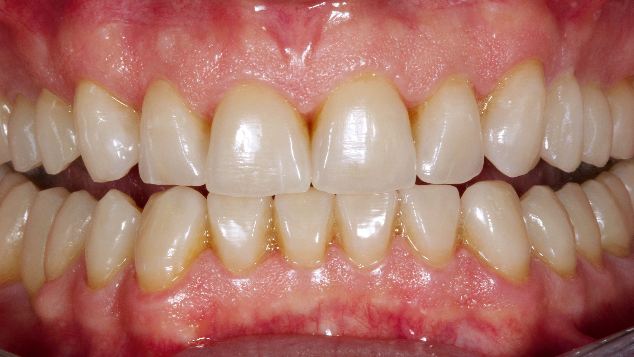 Erfolgreiches Konzept bei Bruxismus - dentaldialogue