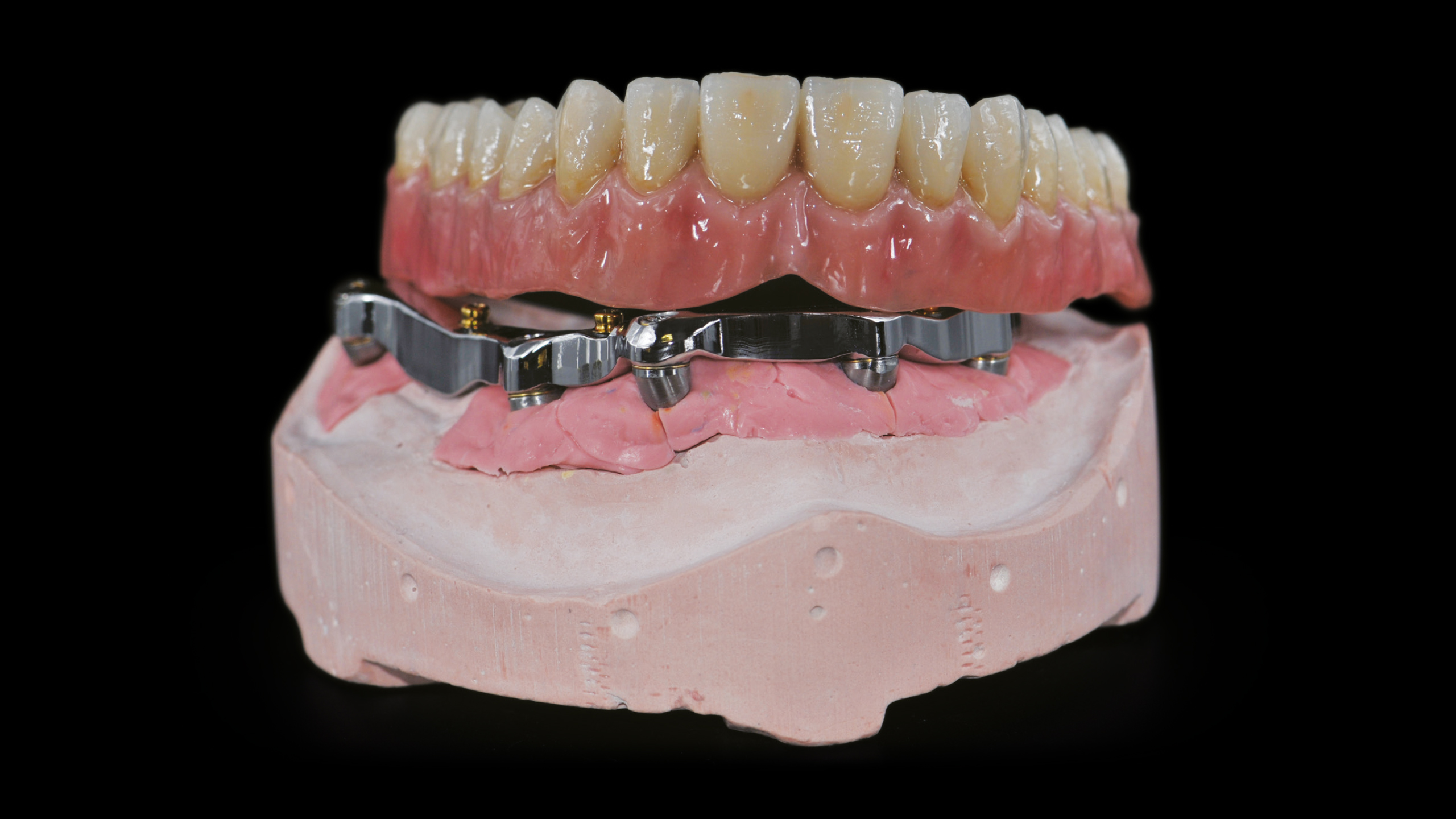 Digitale Stegprothese im Oberkiefer - dentaldialogue